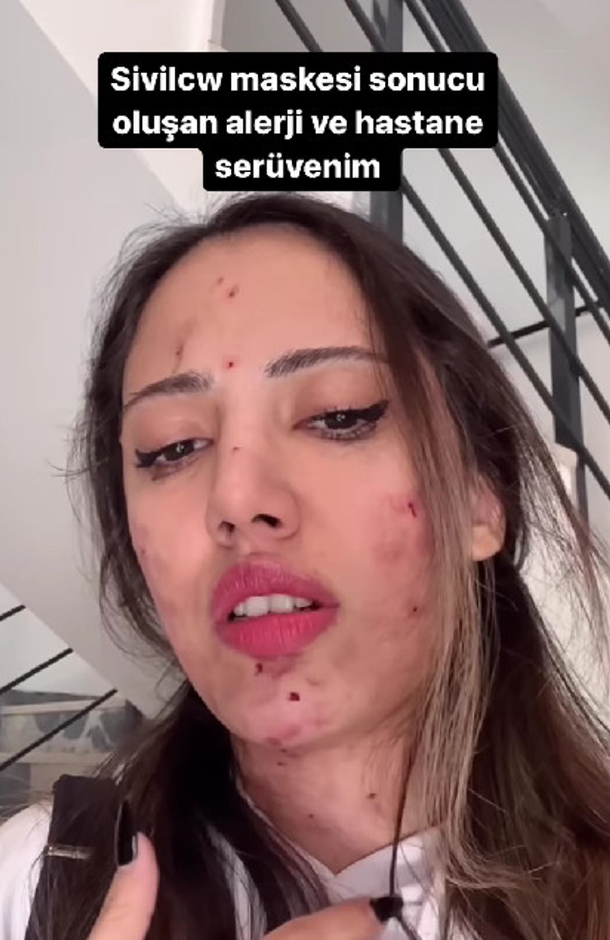 Sivilce maskesi yüzünden acillik olan TikTok fenomeni Sivilce maskesi yüzünden acillik olan TikTok fenomeni