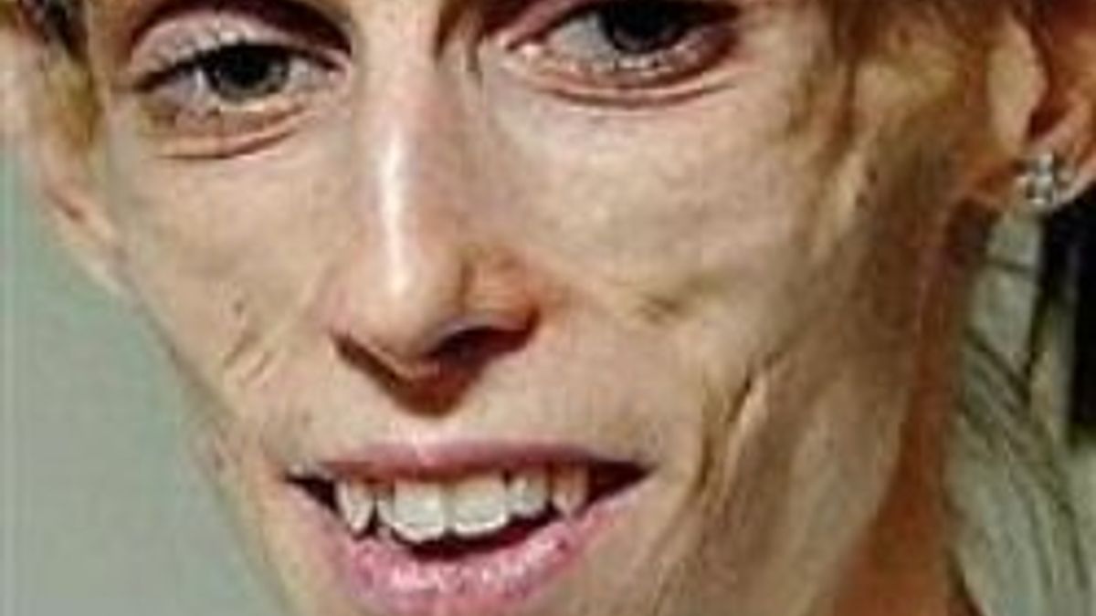 Anoreksiya hastalığına 16 yıl direndi