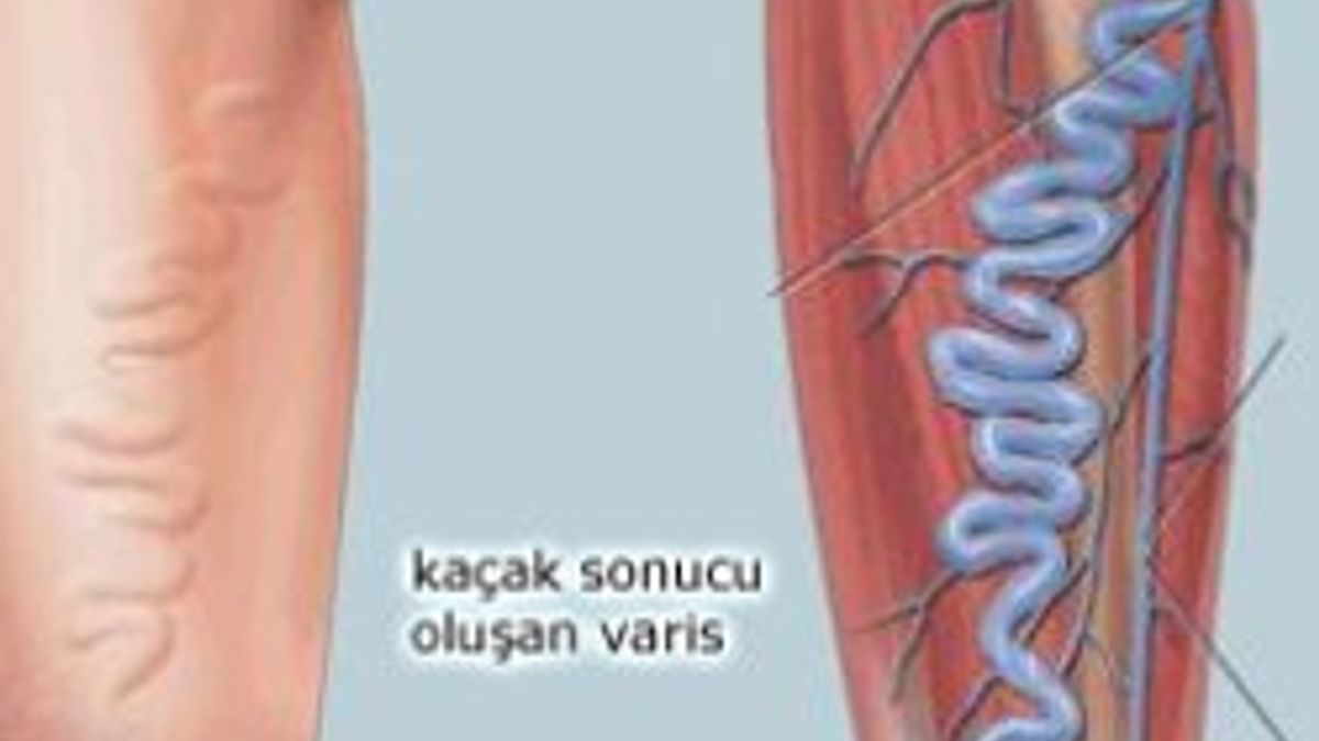 Varis nedir