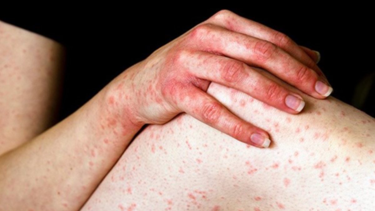 What is anaphylaxis ? – Kimdeyir