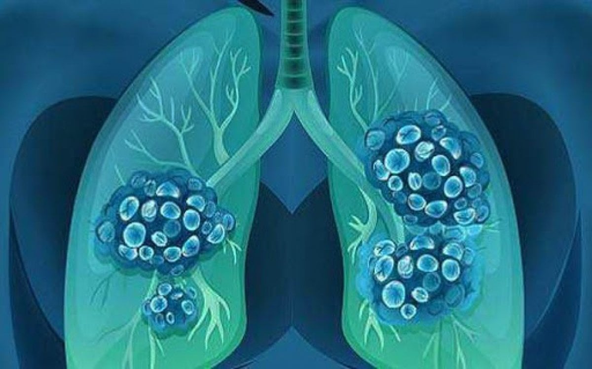 What is bronchiolitis and what are its symptoms? What causes ...