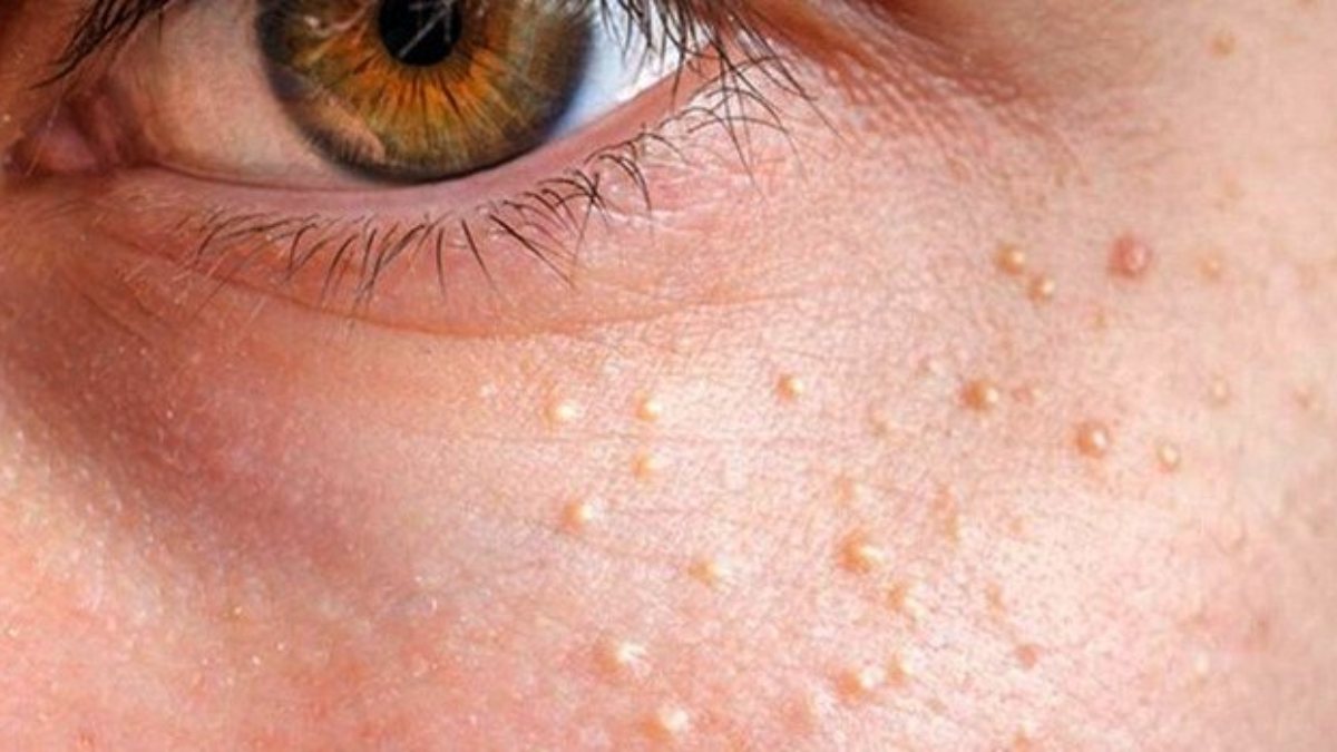 What are comedones – Kimdeyir