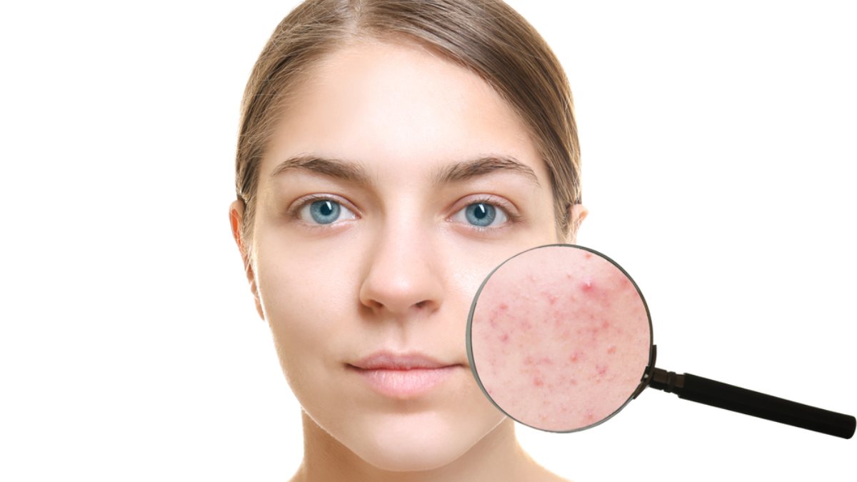 Double mask use triggers mechanical acne – Kimdeyir