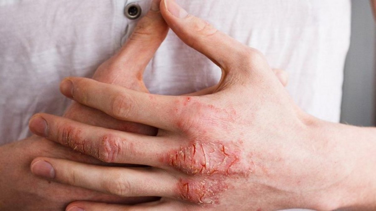 What is atopic dermatitis ? – Kimdeyir