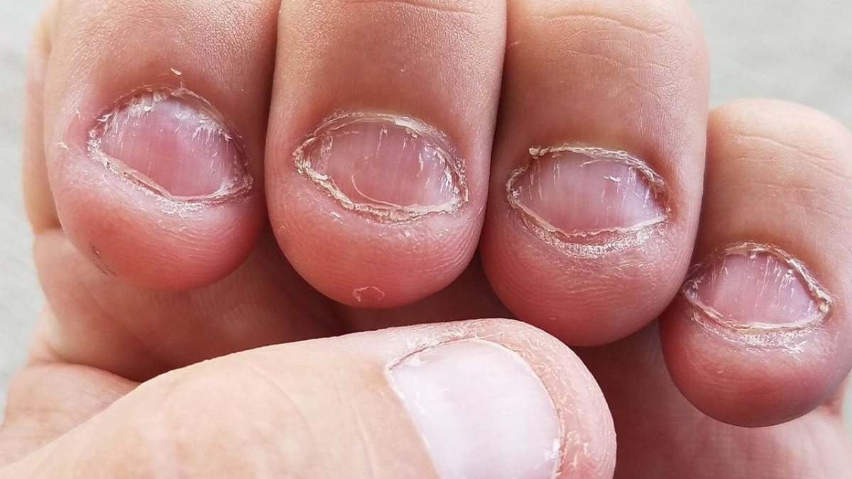 What is onychophagia? It invites Covid-19. – Kimdeyir