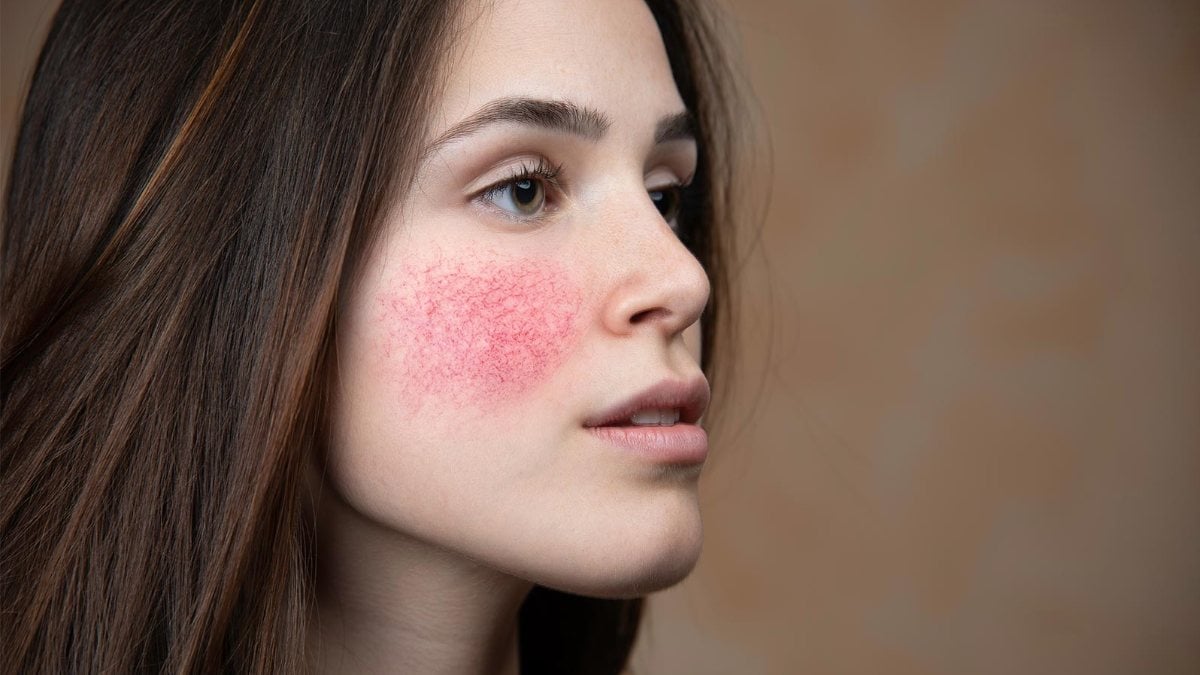 Hidden disease of fair-skinned and colored-eyed people: Rosacea – Kimdeyir
