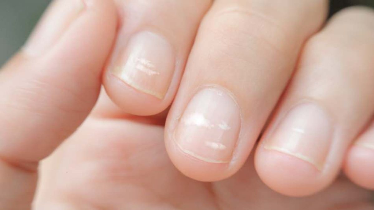 Causes of lines on nails – Kimdeyir