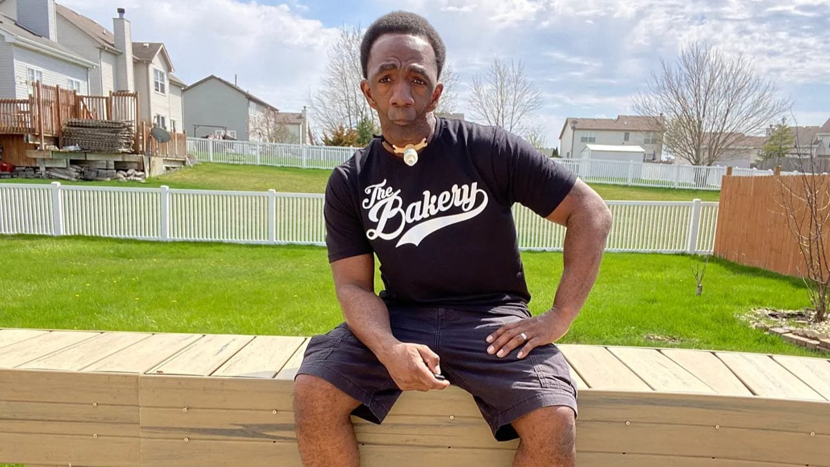 The life story of Joseph Williams, born chinless in the USA – Kimdeyir