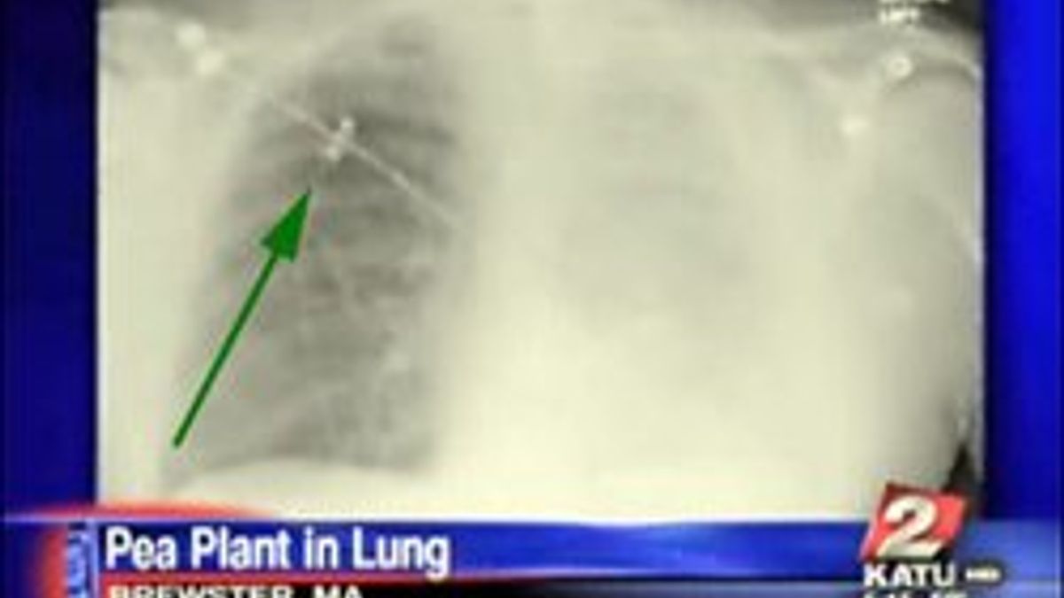 Akciğerinde bezelye filizlendi