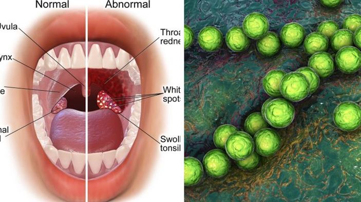 Kabusun yeni adı: Strep A virüsü nedir, nasıl bulaşır ve belirtileri ...